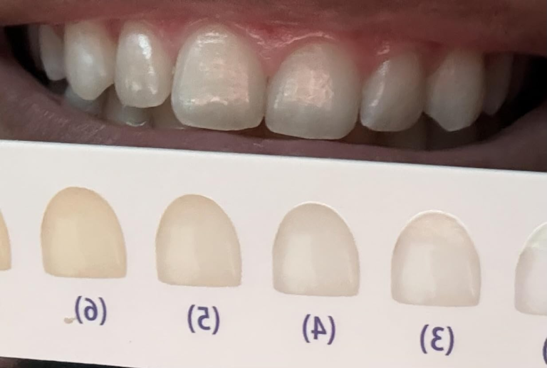 Do GuruNanda Teeth Whitening Strips Really Work? My Honest Experience ...
